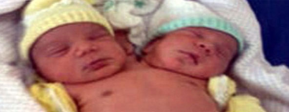 Two Headed Babies Child Born With Two Heads In Syrian City Of Idlib